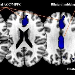 Brain Regions Of Decreased Restingstate Brain Activity In Patients