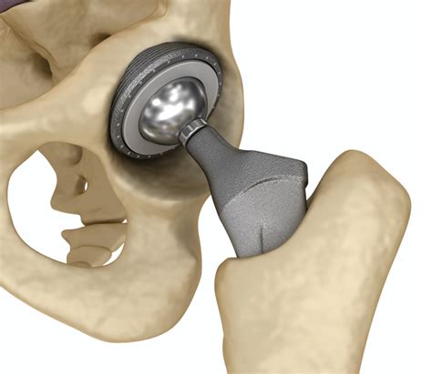 Best Of 2018 Minimizing Destructive Material Testing Today S Medical Developments