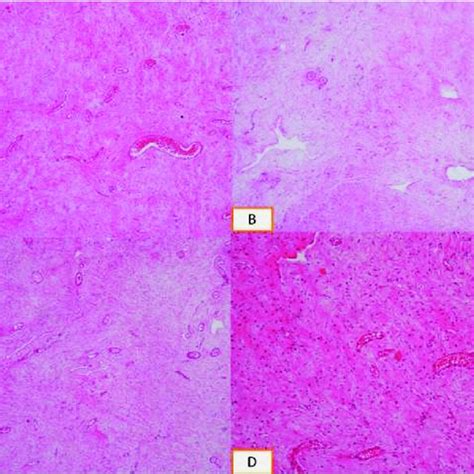 This Tumor Is Composed Of Spindle Cells And Medium Size To Large