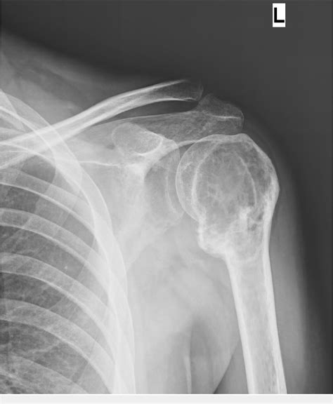 Figure 2 From Salvage Treatment Of Aggressive Giant Cell Tumor Of Bones With Denosumab
