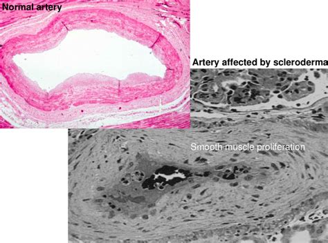 Scleroderma Flashcards Memorang