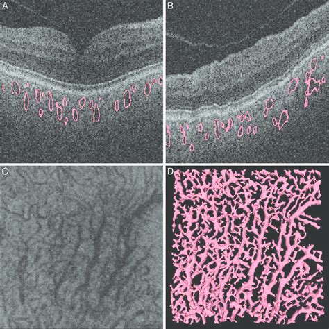 Visualization Of Choroidal Vessel Segmentation Panels A And B Show Download Scientific