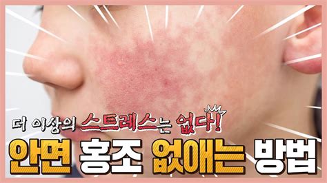 원인을 제거하는 것이 중요하다 안면홍조 없애는 방법 Youtube