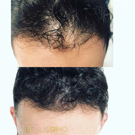 Prp Hair Loss Treatment Bellissimo Clinic