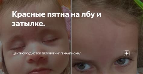Красные пятна на лбу и затылке Центр сосудистой патологии ГЕМАНГИОМА Дзен
