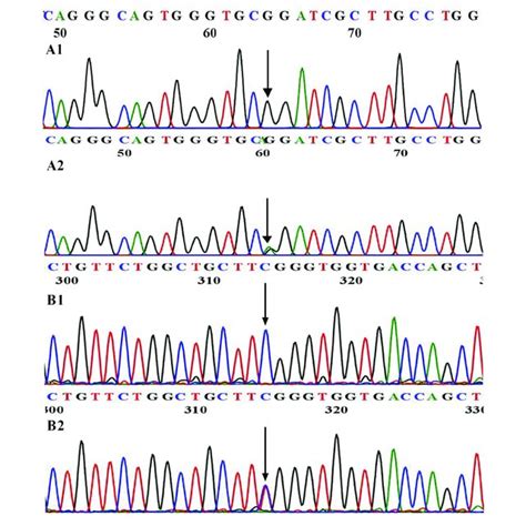 Sequence Traces Of Exon 12 In Duox2 Gene Showing The Nonsense Mutation
