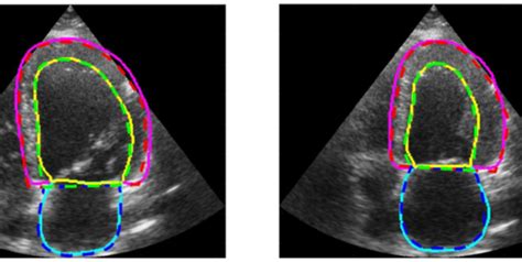 Camus Human Heart Data Kaggle