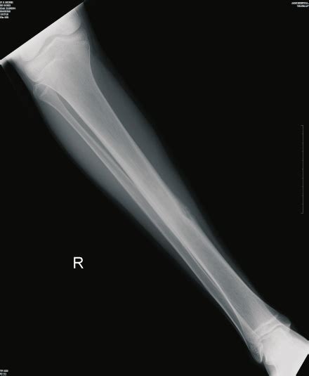 Radiograph Of Right Tibia Showing Diaphyseal Cortical Lesion With Download Scientific Diagram