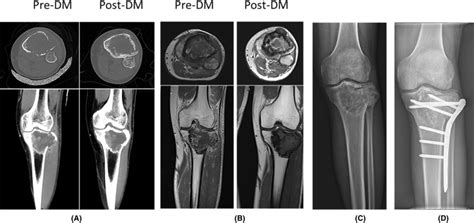 A 35‐year‐old Men Who Was Diagnosed With Giant Cell Tumor Gct Of Download Scientific Diagram