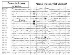 EEG Examples Quizlet