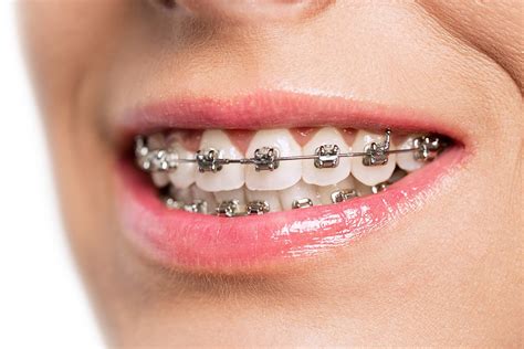 How Braces Straighten Teeth