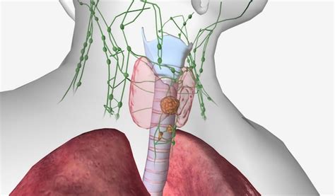 Premium Photo In Stage Iii Thyroid Cancer The Tumor May Be Larger