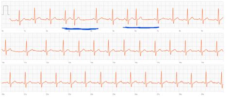 Pac Pvc Happens After Exertion R Pvcs