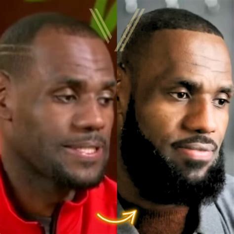 Lebron James Hair Transplant Before And After Transformation