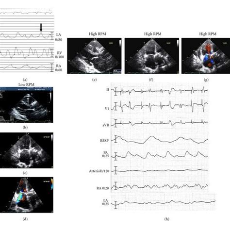 Lvad Speed Settings Columns A Minimal Speed B Submaximal Speed
