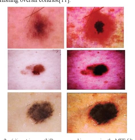 Figure 2 From A Hybrid Feature Extraction Method For Skin Lesion Detection Semantic Scholar