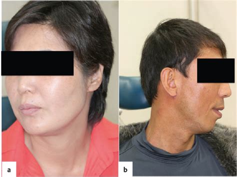 9 Robotic Assisted Neck Dissection Ento Key