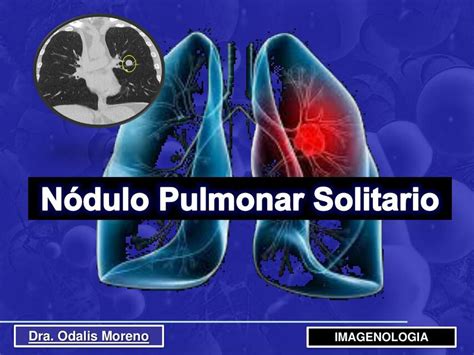 📸 Nodulo Pulmonar Solicitario 🫁 ImagenologÍa 🩻 Dra Odalis Moreno Udocz