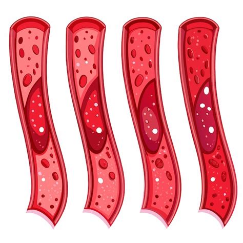 Blood Clot Diagram On A Isolated White Background 25 Premium Ai