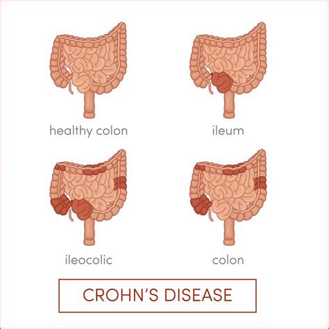 Crohns Disease Treatment Atlanta Ibd And Ibs Stockbridge
