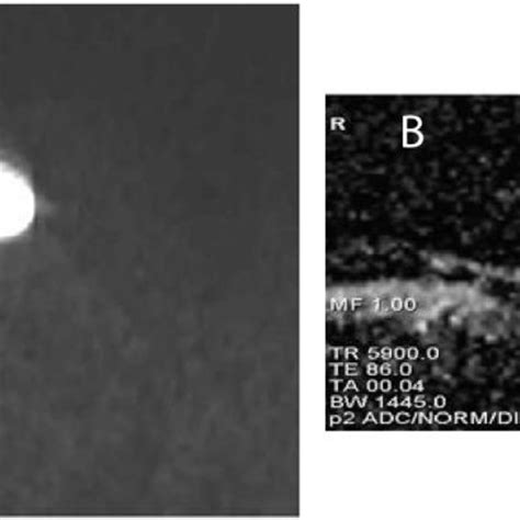 On Diffusion Weighted Imaging Dwi Lesion Showed Markedly Diffusion