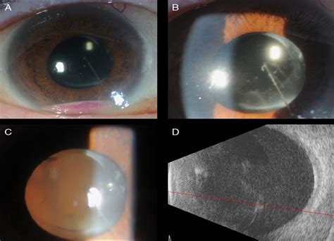 Intravitreal Injections And Endophthalmitis International Ophthalmology Clinics