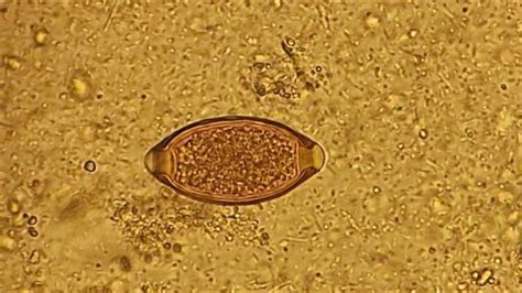 Trichuris Trichiura In Stool Microscopy Youtube
