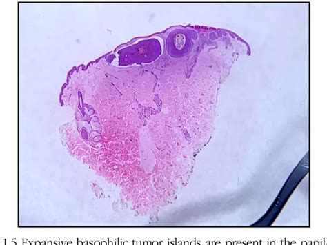 Figure 1 From Ex Vivo Histological Correlation Using Dermoscopy Semantic Scholar