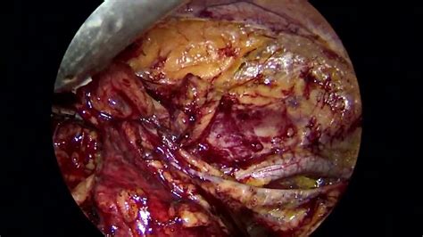 Lap Nephrectomy Youtube