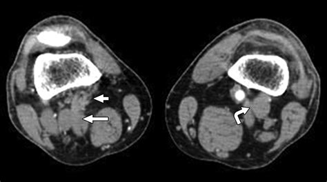 Popliteal Artery Entrapment Syndrome Wikipedia