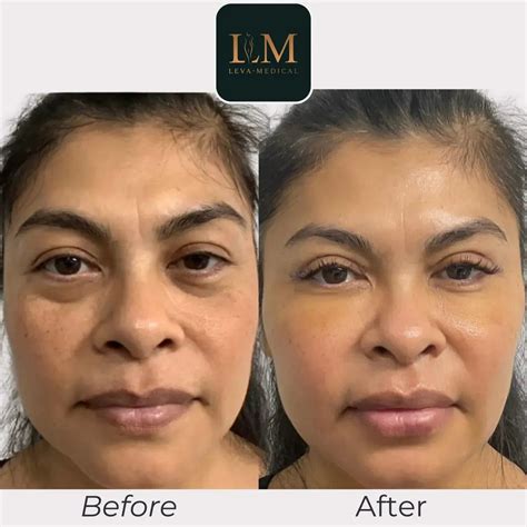 Lower Eyelid Rejuvenation Blepharoplasty