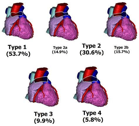 Transverse Sinus Heart