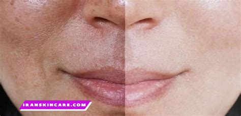 راه های درمان تیرگی پوست صورت روش های خانگی برای روشن کردن پوست تیره