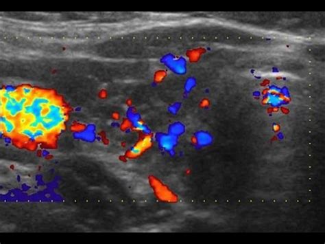 Pediatrics 95 Pediatric Head And Neck Case 952 Thyroid Gland