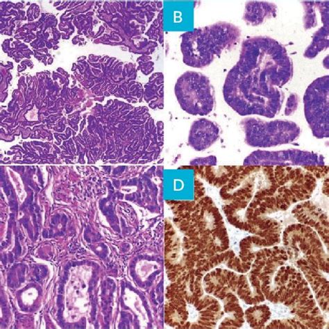 Histology Of Ovary A B D And Colon C Adenocarcinoma With
