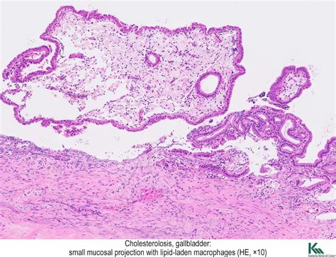 Cholesterolosis Pathology Outlines A Pictures Of Hole 2018