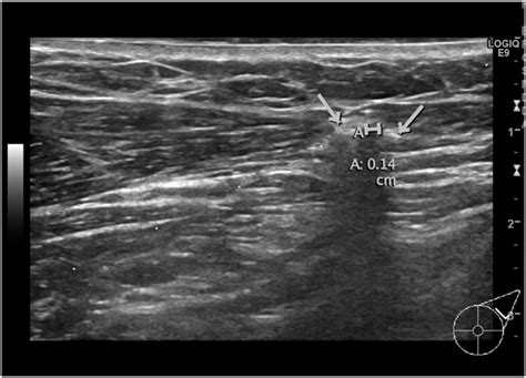 Ultrasound Guided Marking With Radioactive Seed The Bullet Is Marked Download Scientific