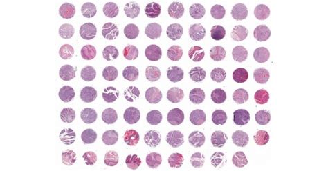 Hn804a Head And Neck Cancer Tissue Array With Normal Tongue Tissues