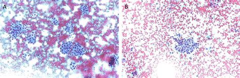 Figure 1 From Indeterminate Thyroid Nodules From Cytology To Molecular Testing Semantic Scholar