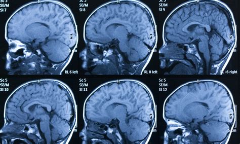 Infant Brain Scans Feda The Foundation For Early Detection Of Autism