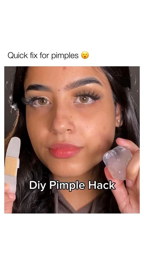 Quickest Way To Remove Pimples Yay Or Nay [video] Pimple Hacks Pimples How To Remove Pimples