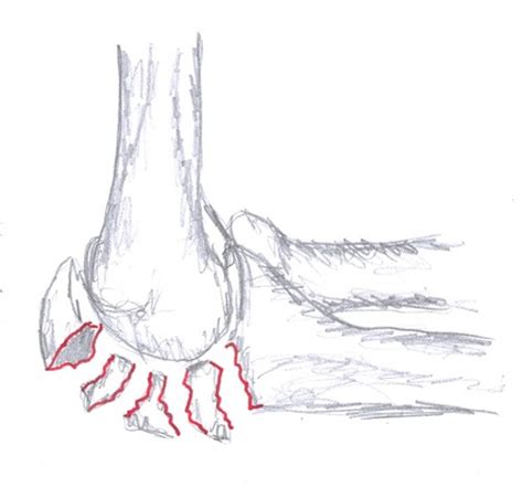 Mayo Classification For Olecranon Fractures Adapted From