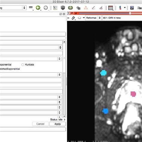 Radiomics Approach A Workflow Of Extracting Radiomic Features I A