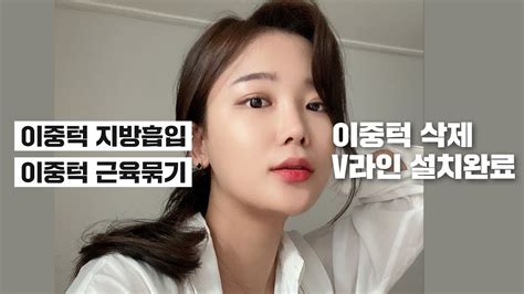 이중턱 지방흡입 And 근육묶기 성형 후기 Youtube