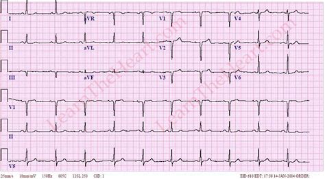 Old Anterior Wall Myocardial Infarction Mi Ecg
