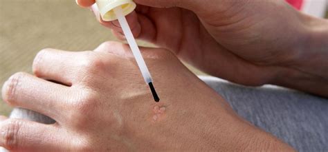 Best Cauterization Clinic For Warts And Skin Tags Removal