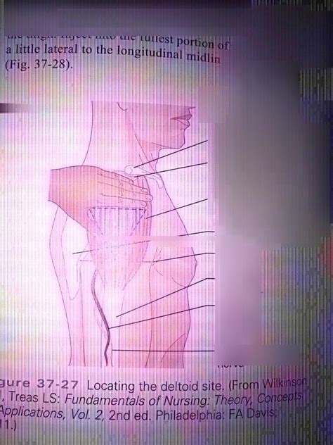Deltoid Injection Site Diagram Quizlet