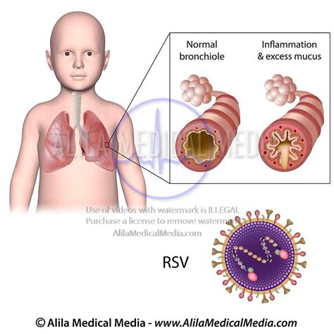 Acute Bronchiolitis
