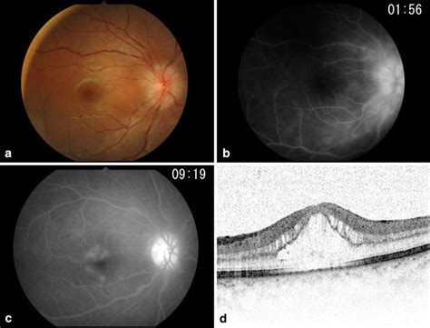 Fundus Photograph Of The Right Eye Case 2 Optic Disk Edema And Download Scientific Diagram