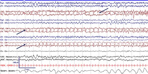 Frontiers Current And Future Uses Of Continuous Eeg In The 55 Off